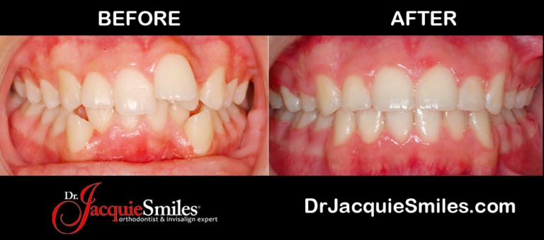 Invisalign Clear Braces Treatment for Crowded Teeth in NYCDr. Jacquie