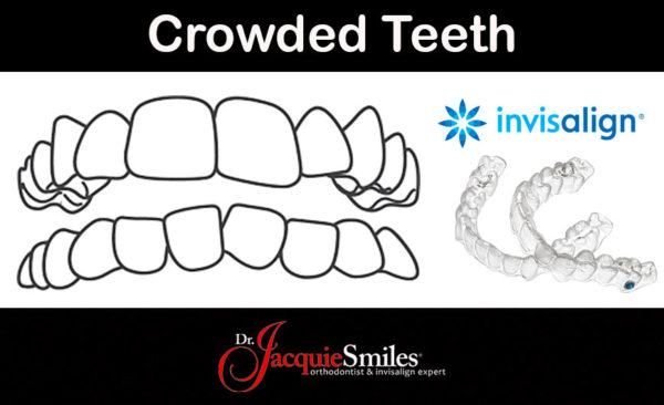 Invisalign Clear Braces Treatment for Crowded Teeth in NYCDr. Jacquie