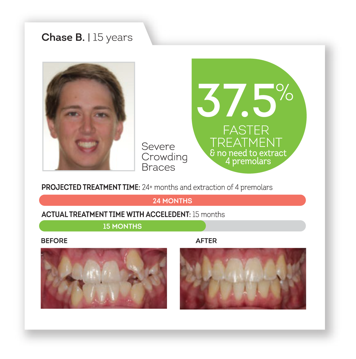 Accelerated Orthodontics with AcceleDent in NYCDr. Jacquie