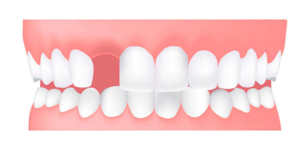 Types of Malocclusions: Causes, Symptoms & TreatmentsDr. Jacquie