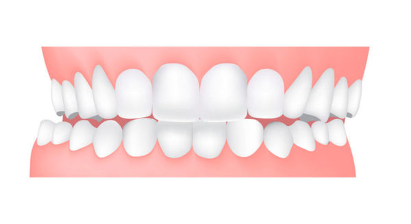 Types of Malocclusions: Causes, Symptoms & TreatmentsDr. Jacquie