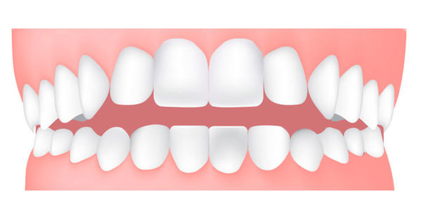 Types of Malocclusions: Causes, Symptoms & TreatmentsDr. Jacquie
