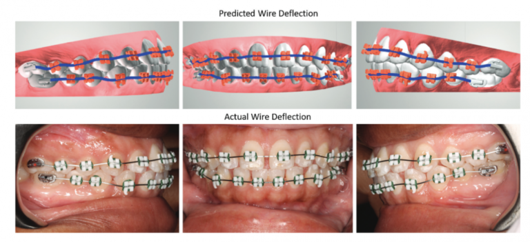 LightForce Orthodontics 3D TechnologyDr. Jacquie
