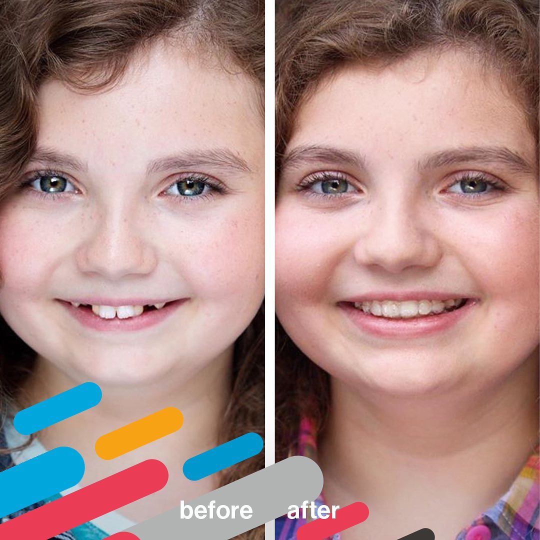 Invisalign Before and After PicturesDr. Jacquie